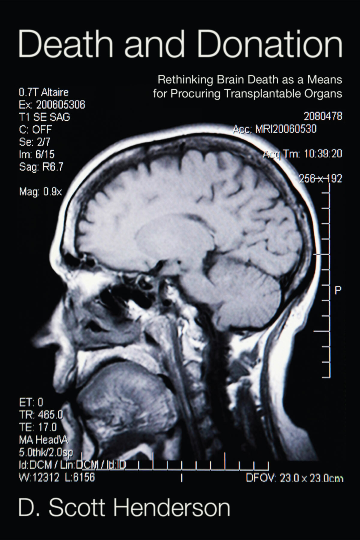 Death and Donation: Rethinking Brain Death as a Means for Procuring ...